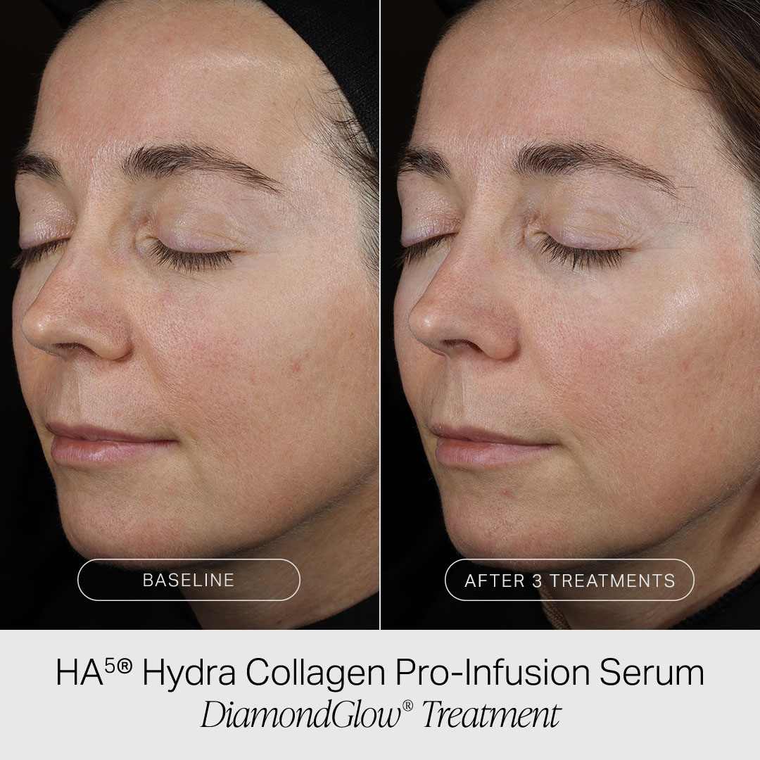 DiamondGlow® HA5® Hydra Collagen Pro-Infusion Serum HCP Calendar ...